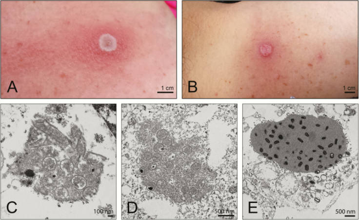 Two more Alaskapox cases reported in Fairbanks area