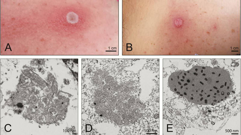 Two more Alaskapox cases reported in Fairbanks area