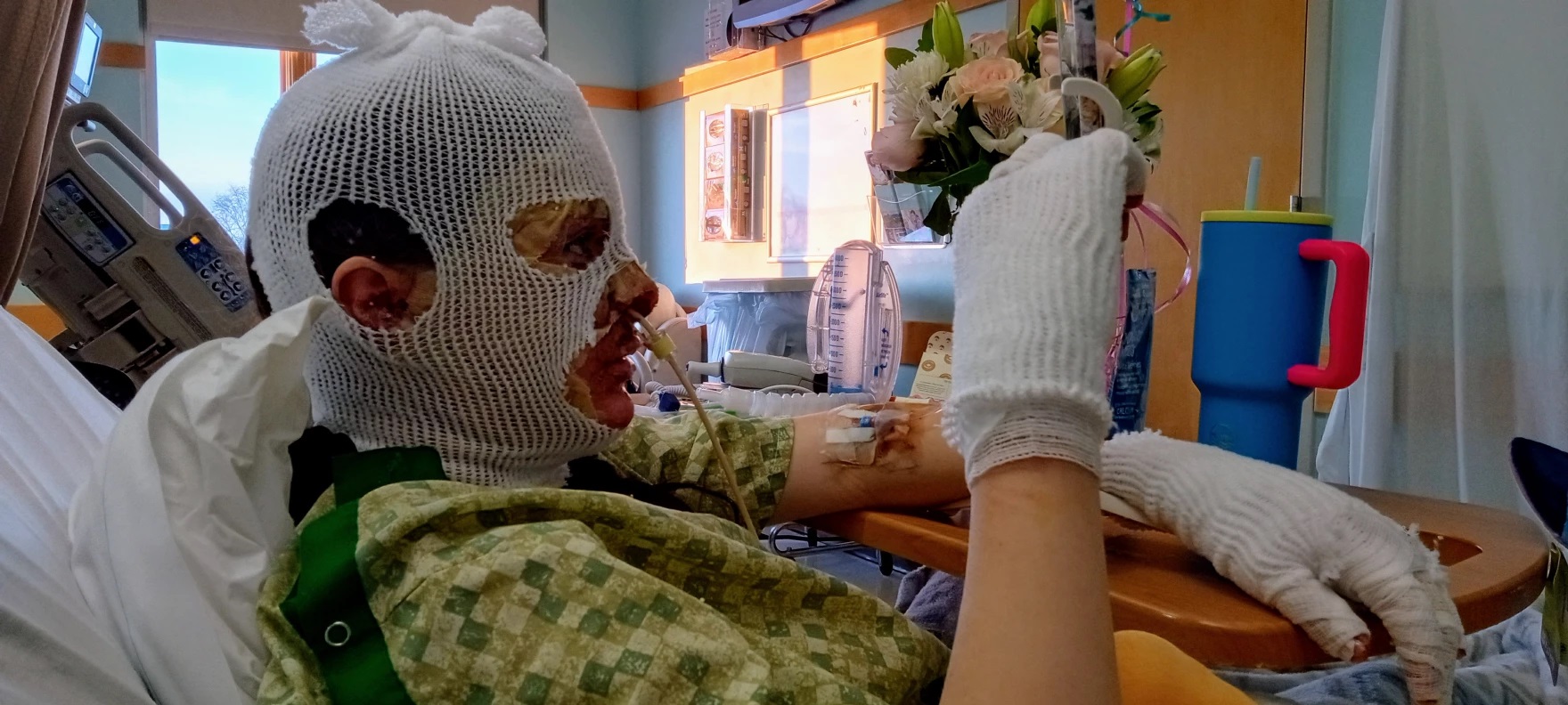 ‘I thought I died’: Burn victim recalls Kodiak bonfire explosion